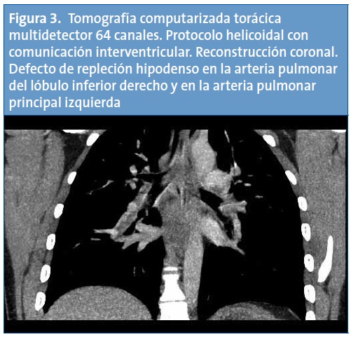 Figura 3. Tomografía computarizada torácica multidetector 64 canales ...
