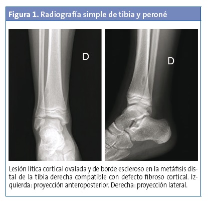 Figura 1. Radiografía simple de tibia y peroné