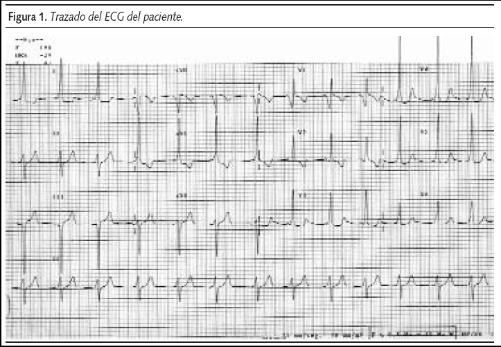 Figura 1. Trazado del ECG del paciente.